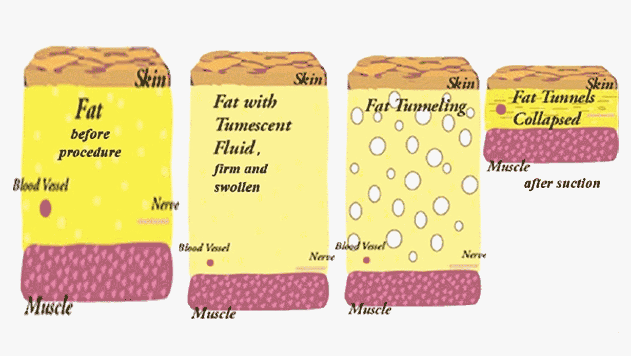 Tumescent Anesthesia - Philadelphia Liposuction Specialty Clinic